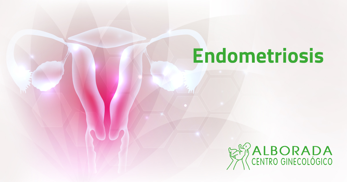 Endometriosis: origen, síntomas y tratamiento